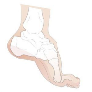 High Foot Arch Pain & Pes Cavus Foot Treatment | The Foot Practice