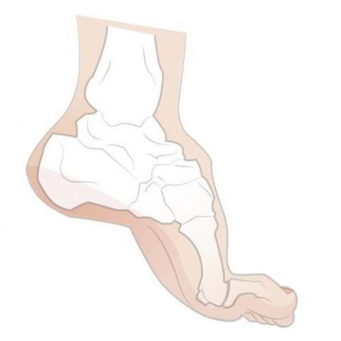 High Foot Arches: Complete Guide to Causes, Symptoms, and Treatment