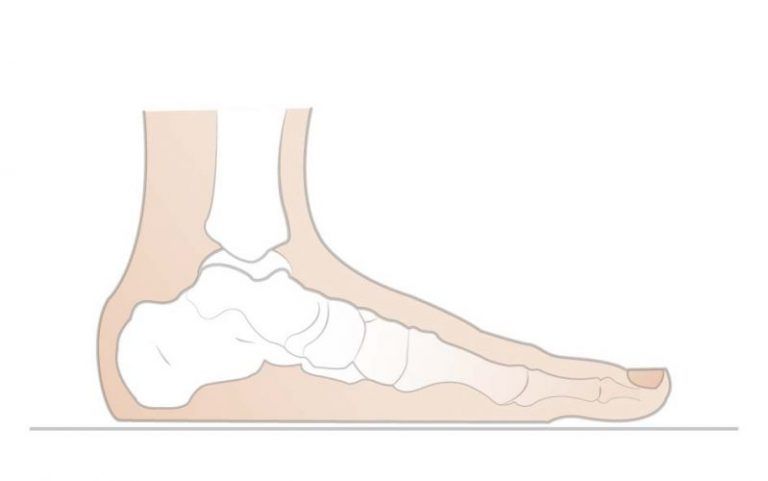 Flat Feet Causes, Symptoms, and Podiatry Treatments in Singapore