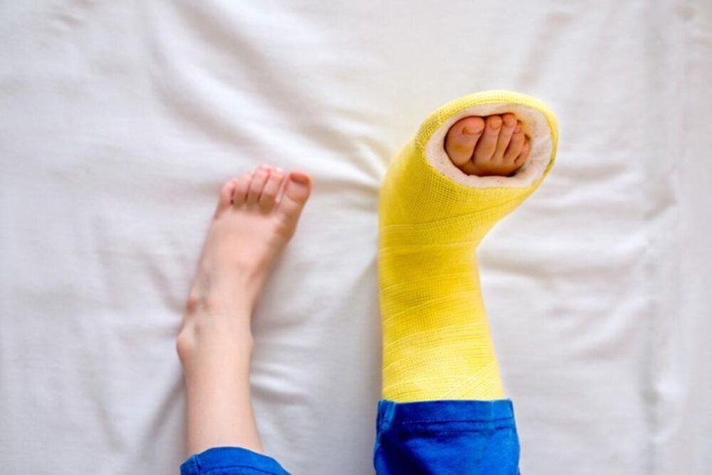 Stress Fractures in Children: Detection, Management, and Long-Term ...