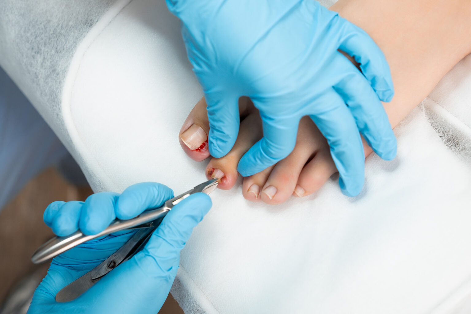 Ingrown Toenail Surgery and Recovery