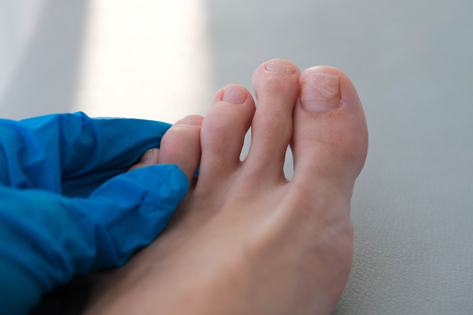 Morton’s Toe: Causes, Symptoms & Expert Podiatric Treatments
