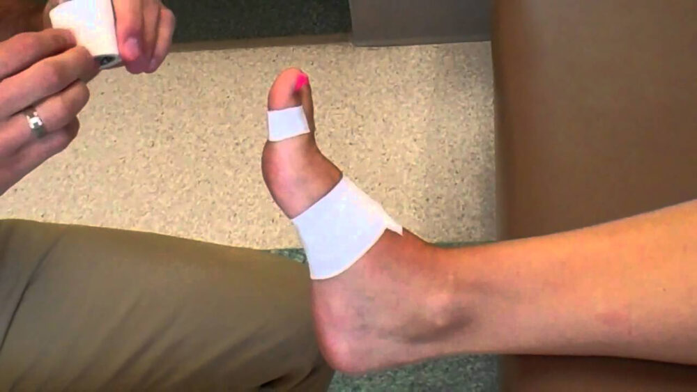 Morton’s Toe: Causes, Symptoms & Expert Podiatric Treatments