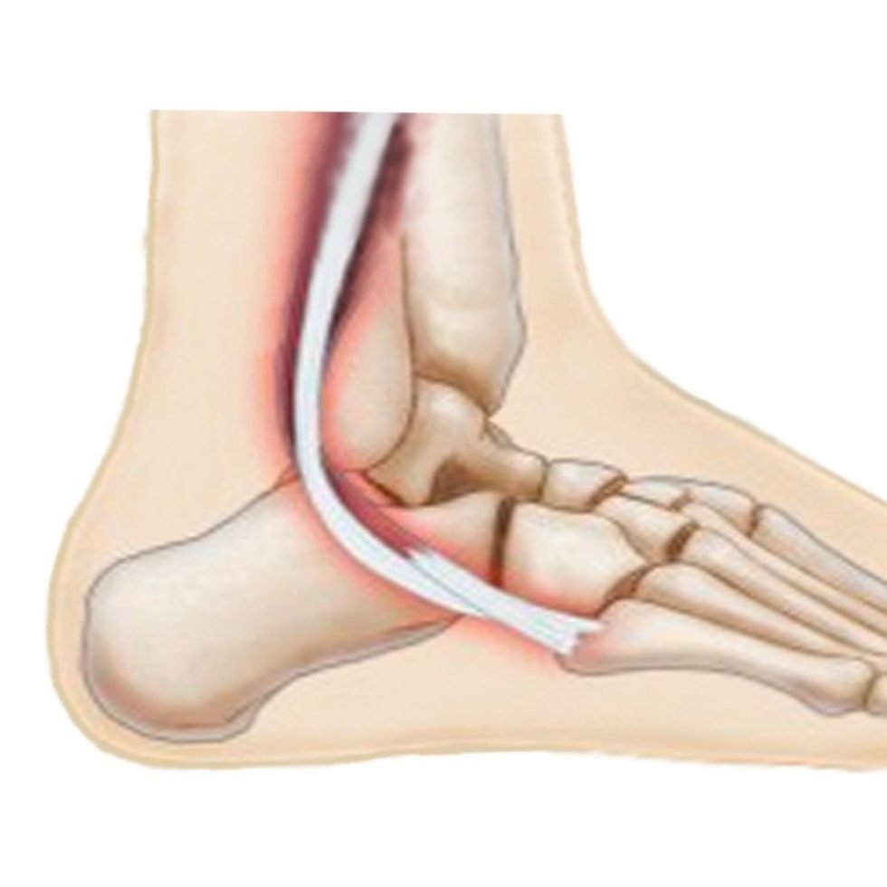 Peroneal Tendonitis Treatment Guide | Peroneal Tenonitis Pain