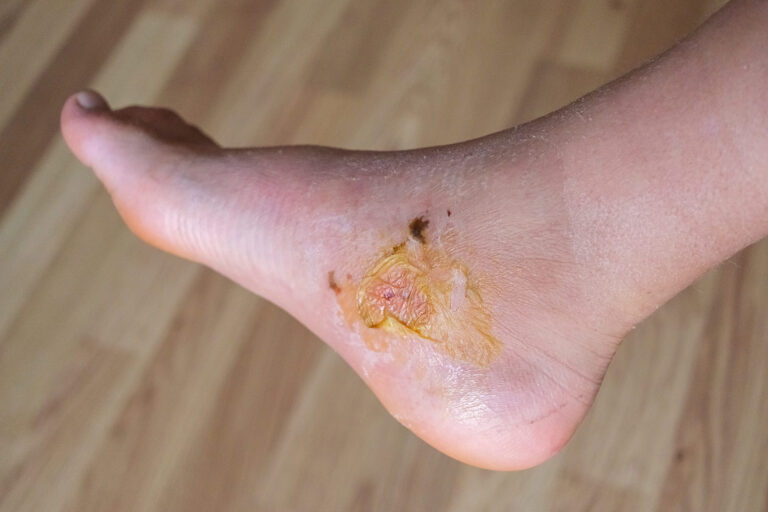 How To Heal and Prevent Foot Blisters | Feet Blister Cure