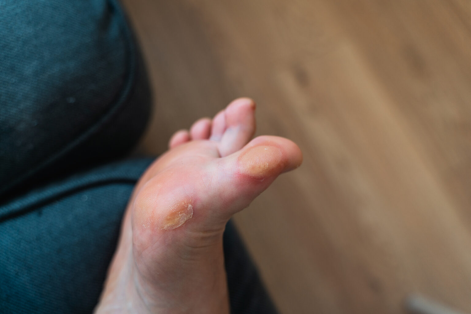 How To Heal and Prevent Foot Blisters | Feet Blister Cure