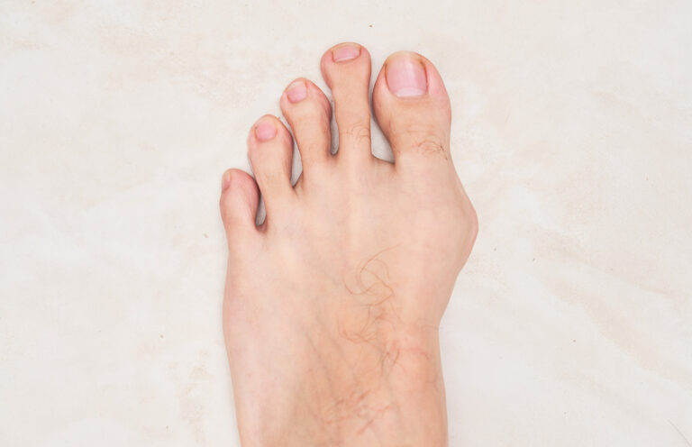 Relieve Pain on Outside of Foot: How Podiatry Helps