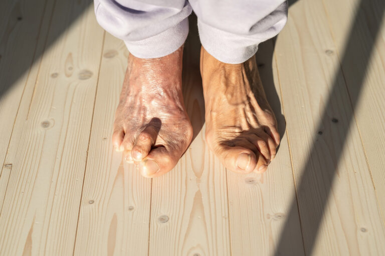 Do Orthotics Help Bunions? Expert Guide to Pain Relief