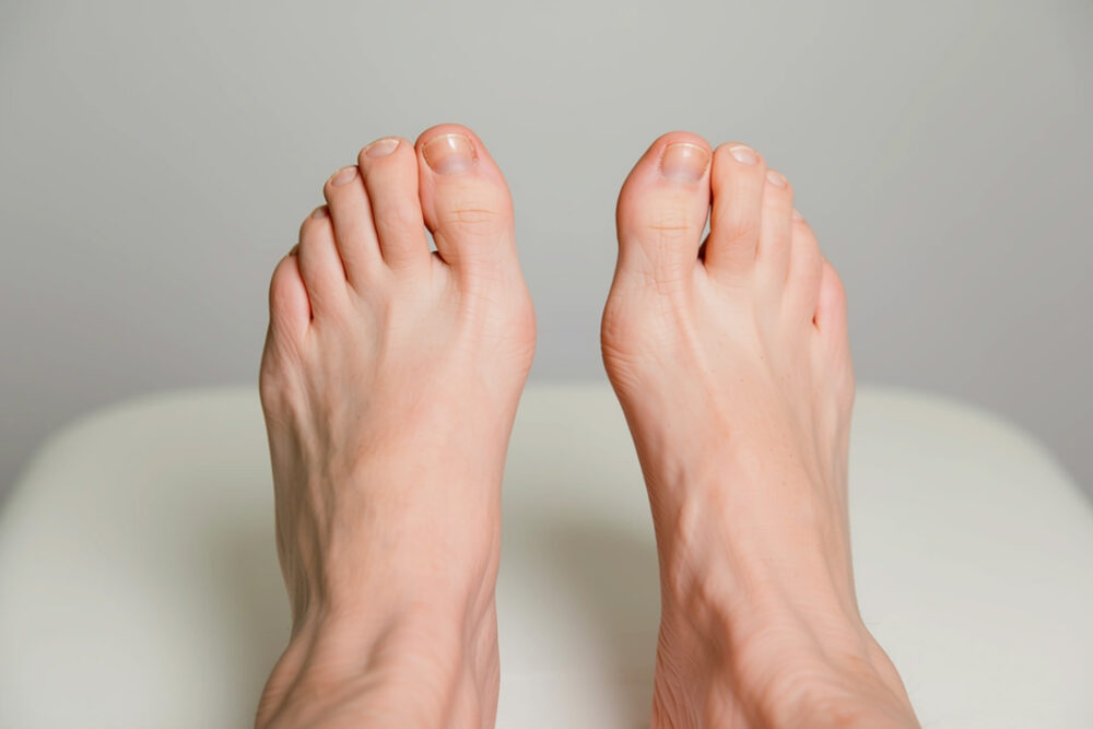Do Orthotics Help Bunions? Expert Guide to Pain Relief