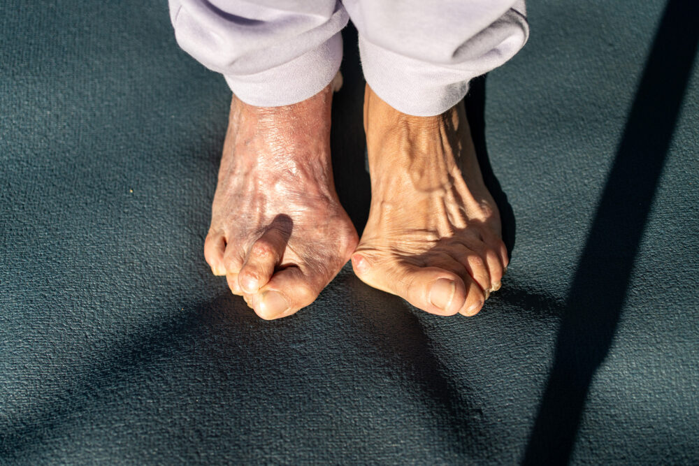 Claw Toe: Causes, Symptoms and Effective Podiatric Treatment