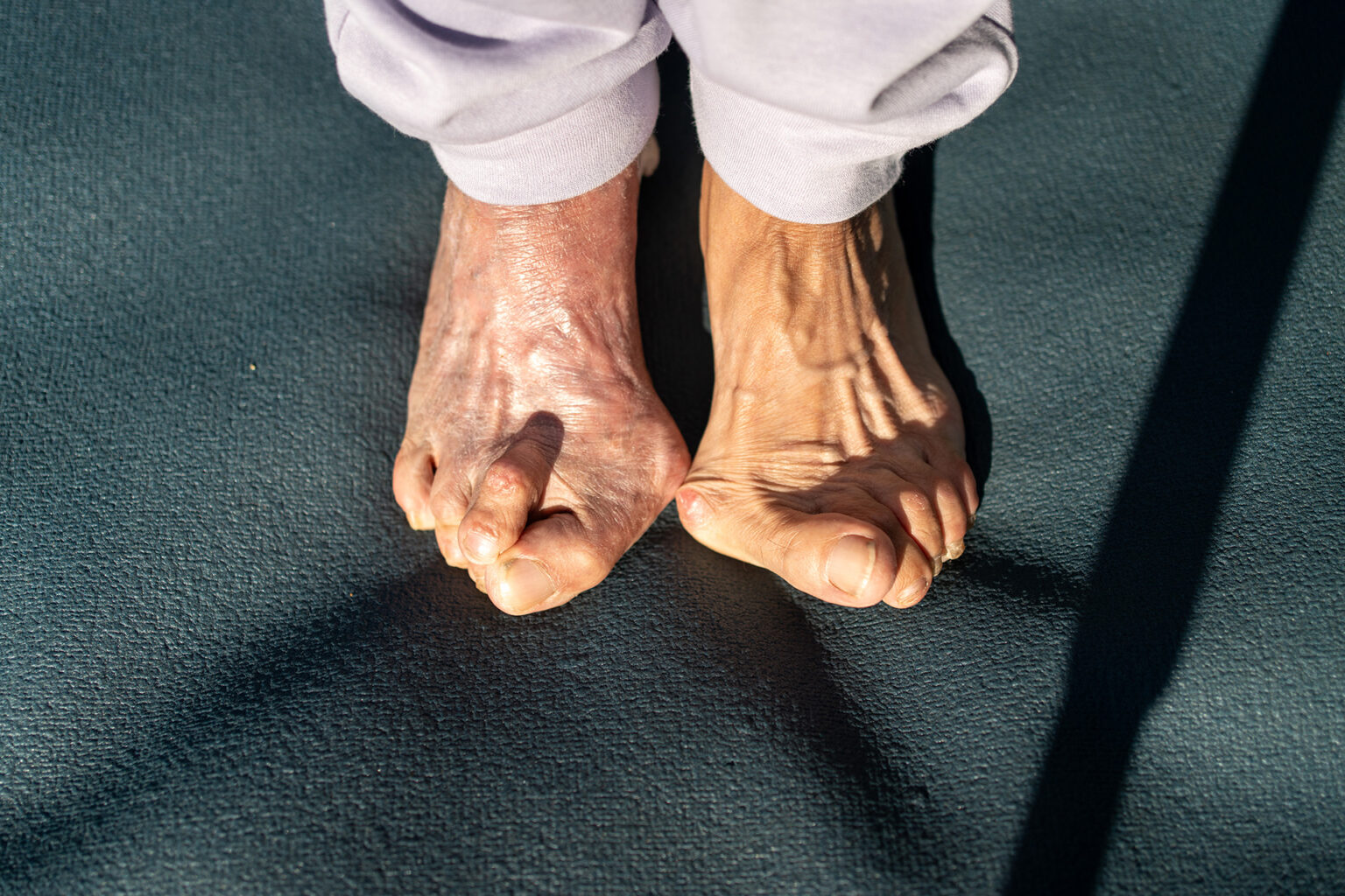 Claw Toe: Causes, Symptoms and Effective Podiatric Treatment