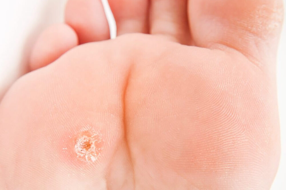 Foot Corn Removal and How Podiatry Helps