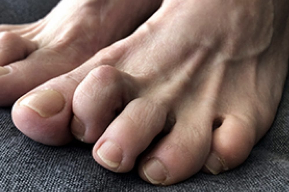 Proper Podiatry Foot Care to Prevent Diabetic Foot Infections