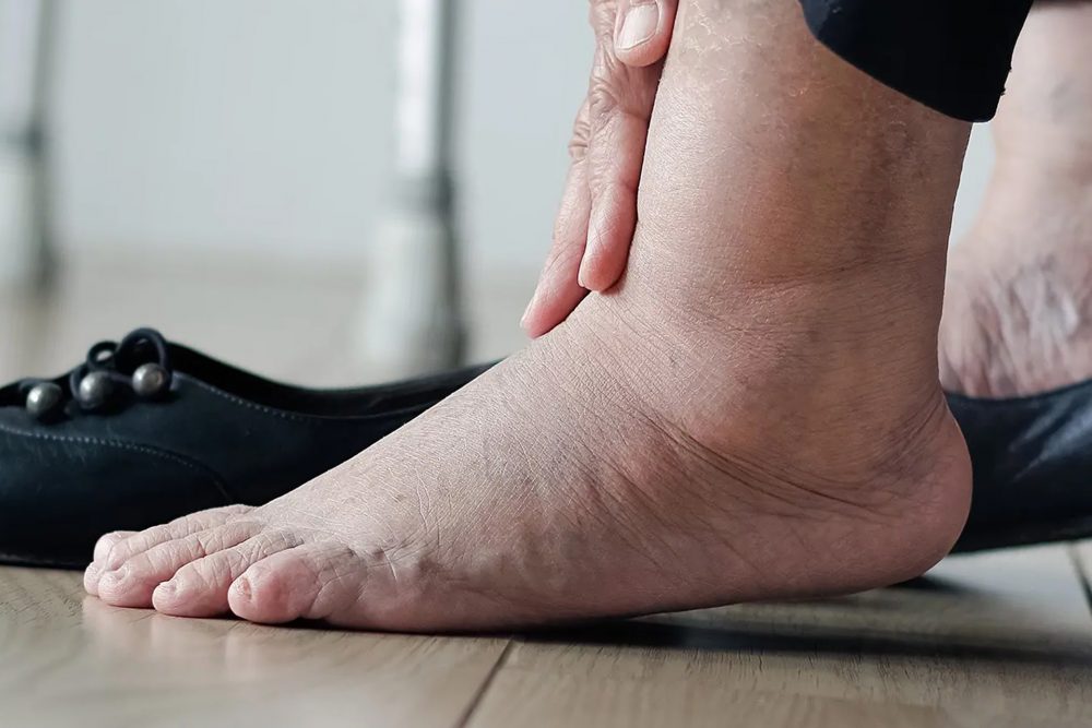 Shockwave Therapy for Plantar Fasciitis