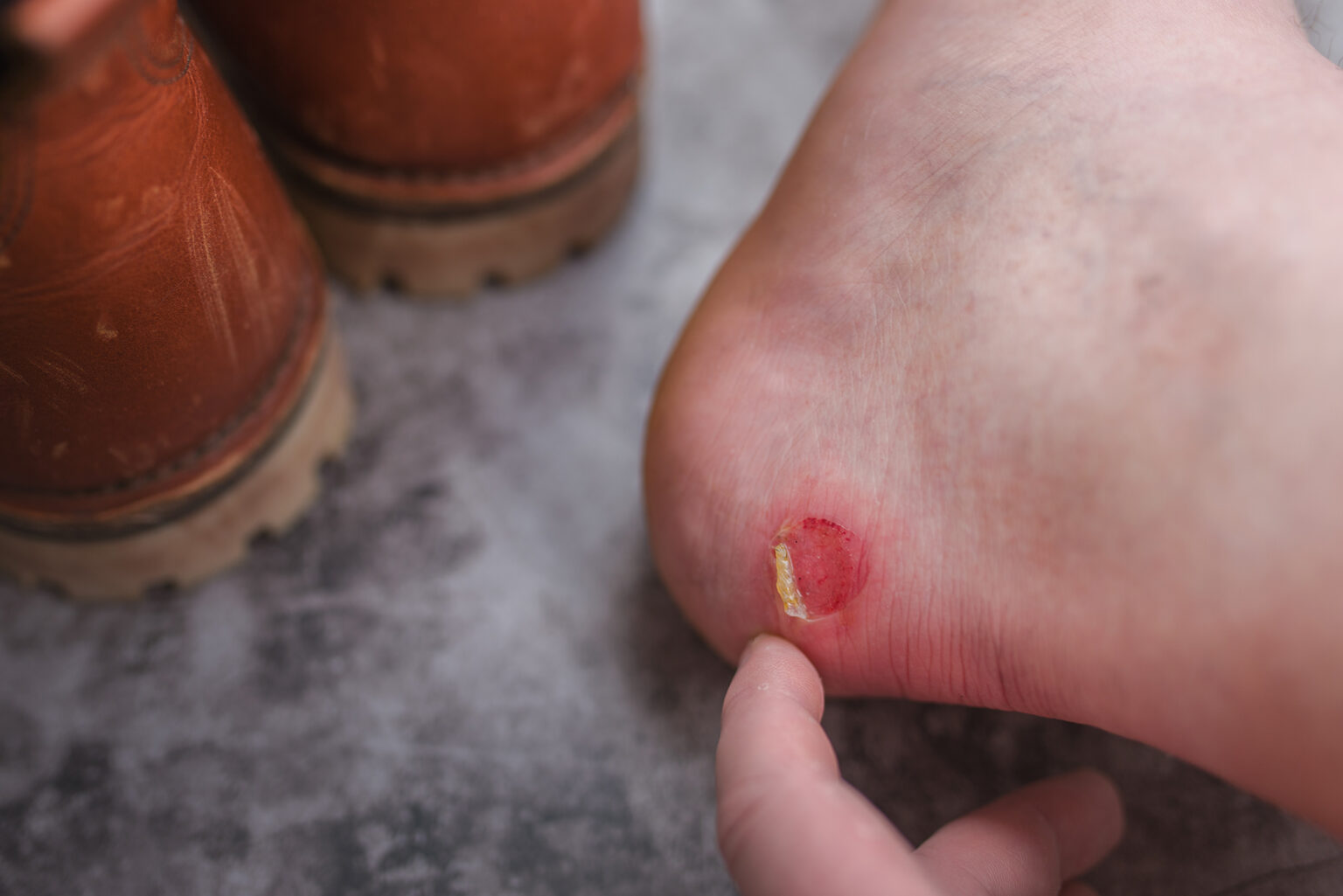 How To Heal and Prevent Foot Blisters | Feet Blister Cure
