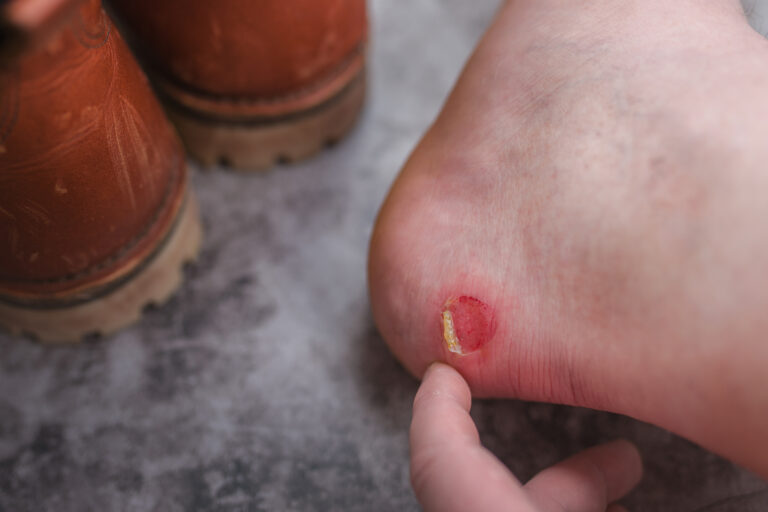 How To Heal and Prevent Foot Blisters | Feet Blister Cure