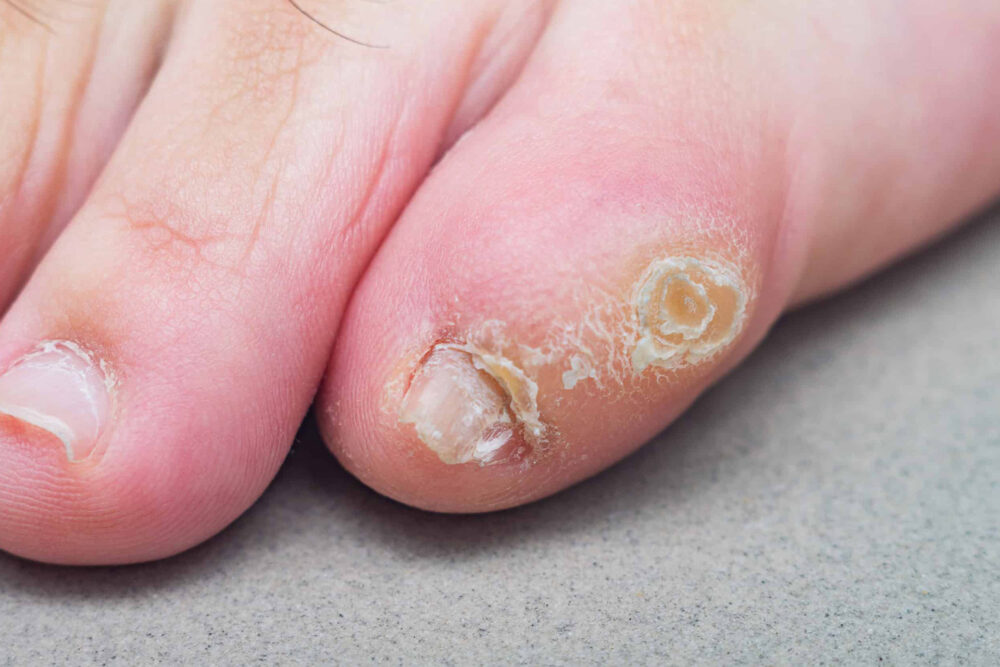 Professional Corn Removal in Singapore | The Foot Practice
