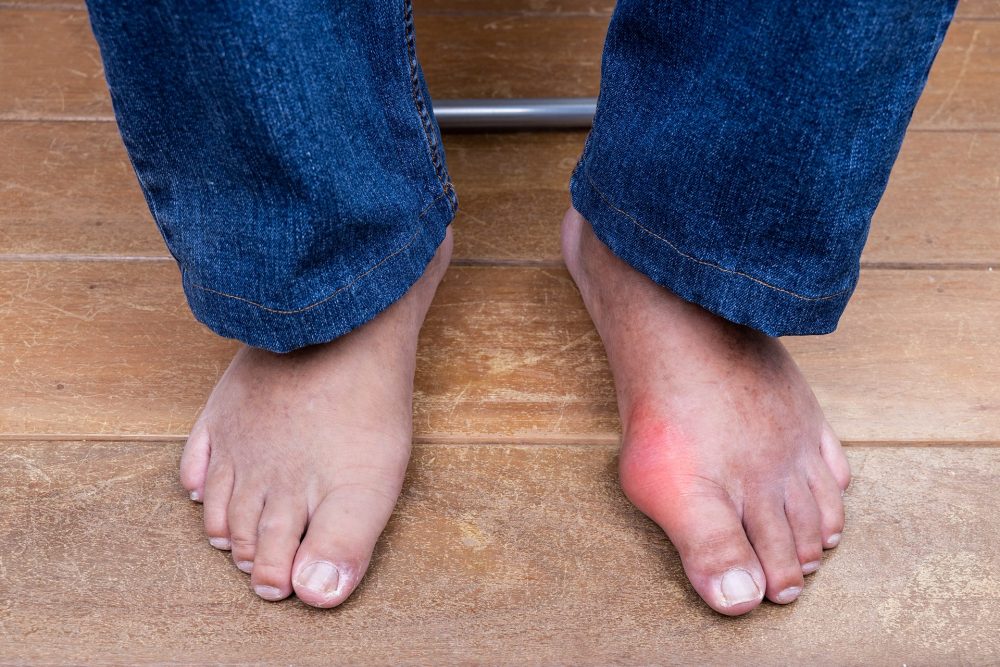 Podiatry Gout Treatment in Singapore | The Foot Practice