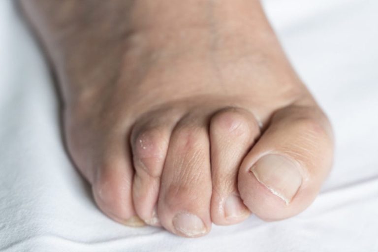 Hammertoe Correction without Surgery - The Foot Practice Podiatry Singapore