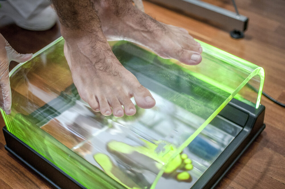 High Foot Arches: Complete Guide to Causes, Symptoms, and Treatment
