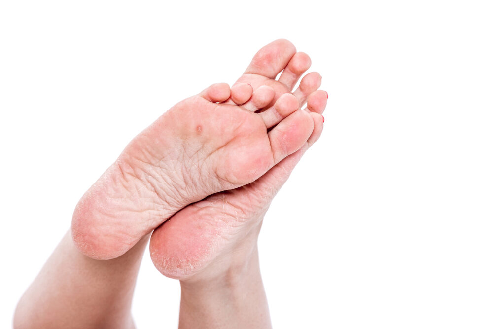 Foot Corn Removal and How Podiatry Helps