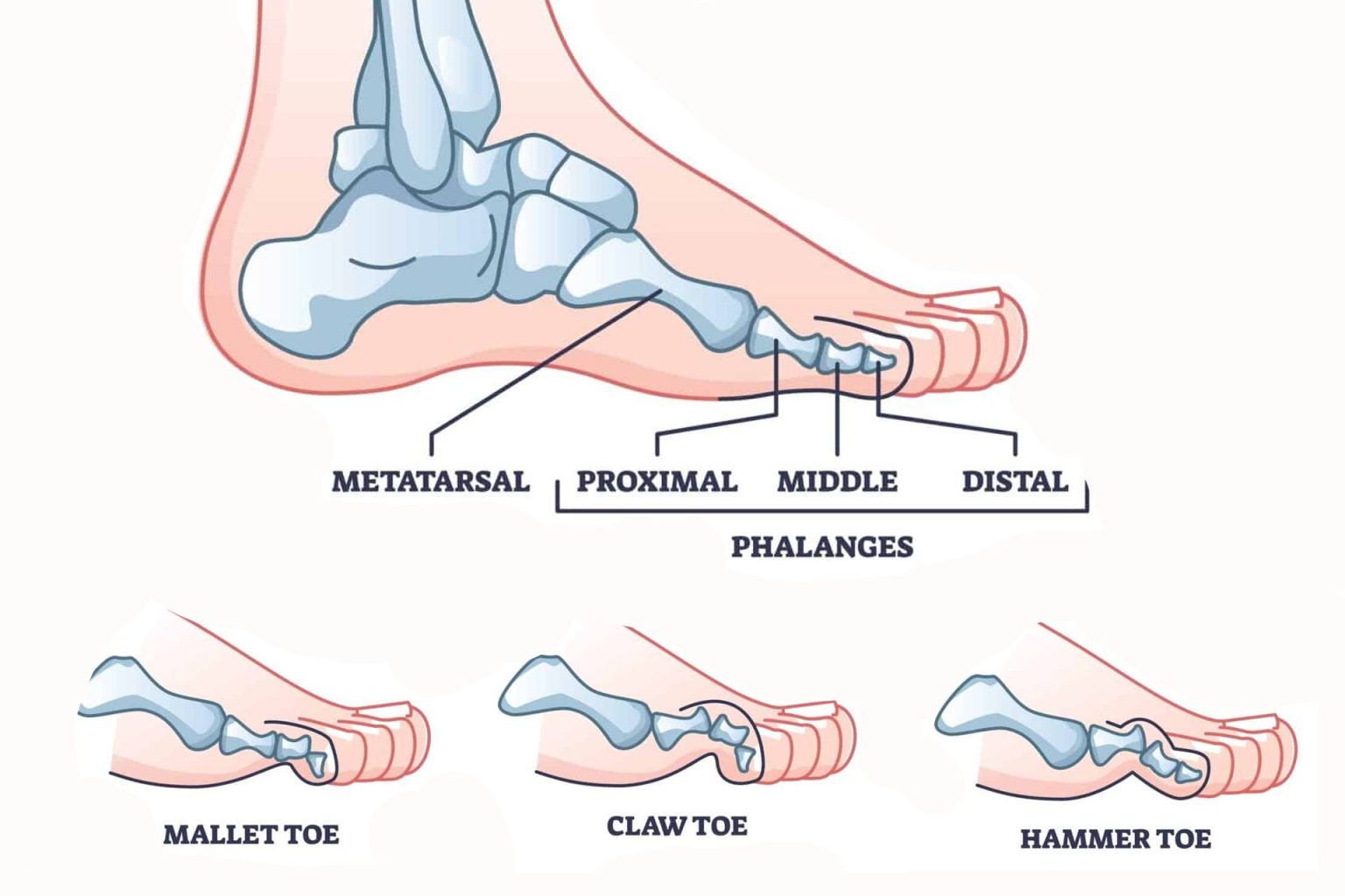 Hammertoe Correction without Surgery - The Foot Practice Podiatrist ...