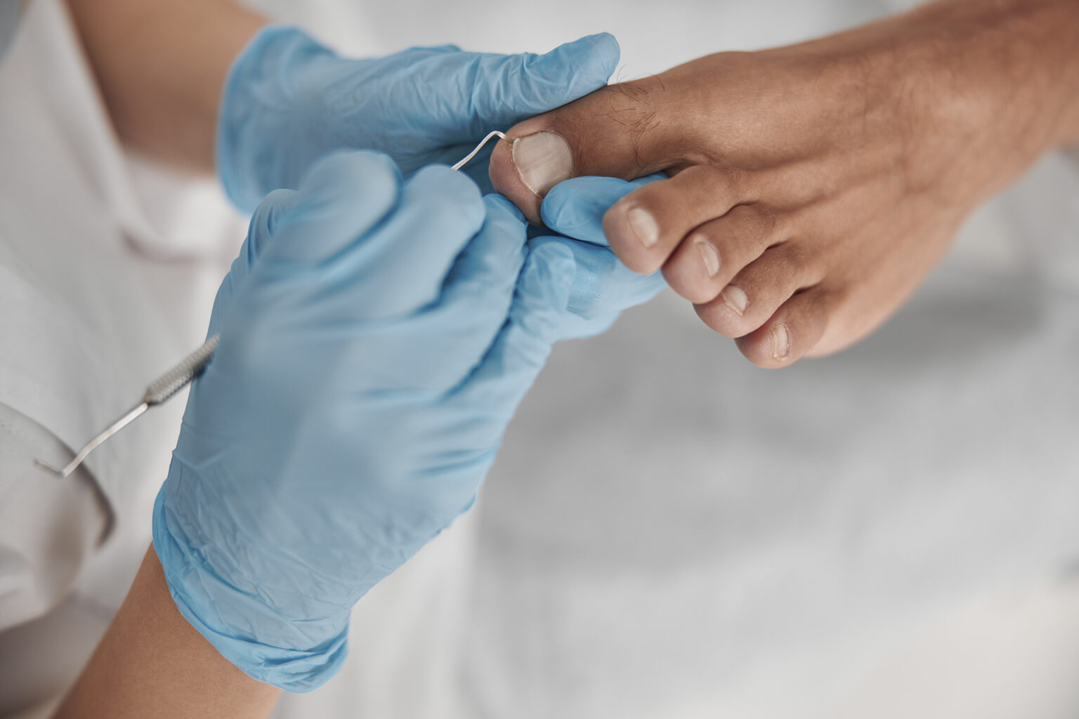 Nail Avulsion | The Foot Practice Podiatrist Singapore