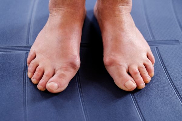 Hammertoe Correction without Surgery - The Foot Practice Podiatrist ...