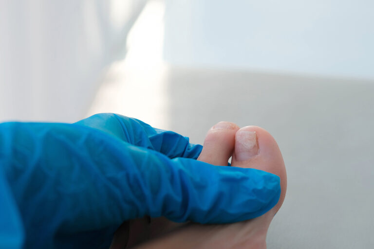 Paronychia Symptom, Causes and Podiatric Treatment