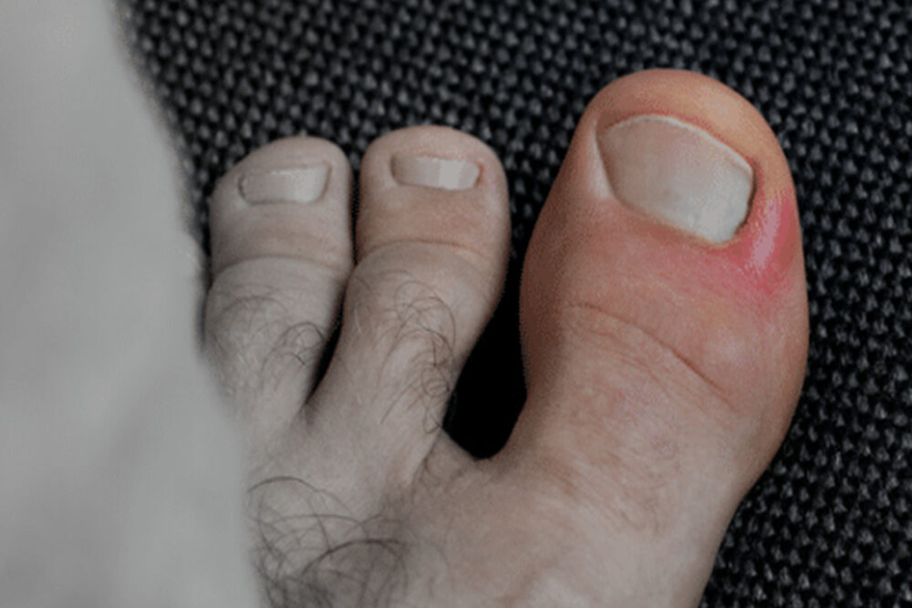 Paronychia Symptom, Causes and Podiatric Treatment