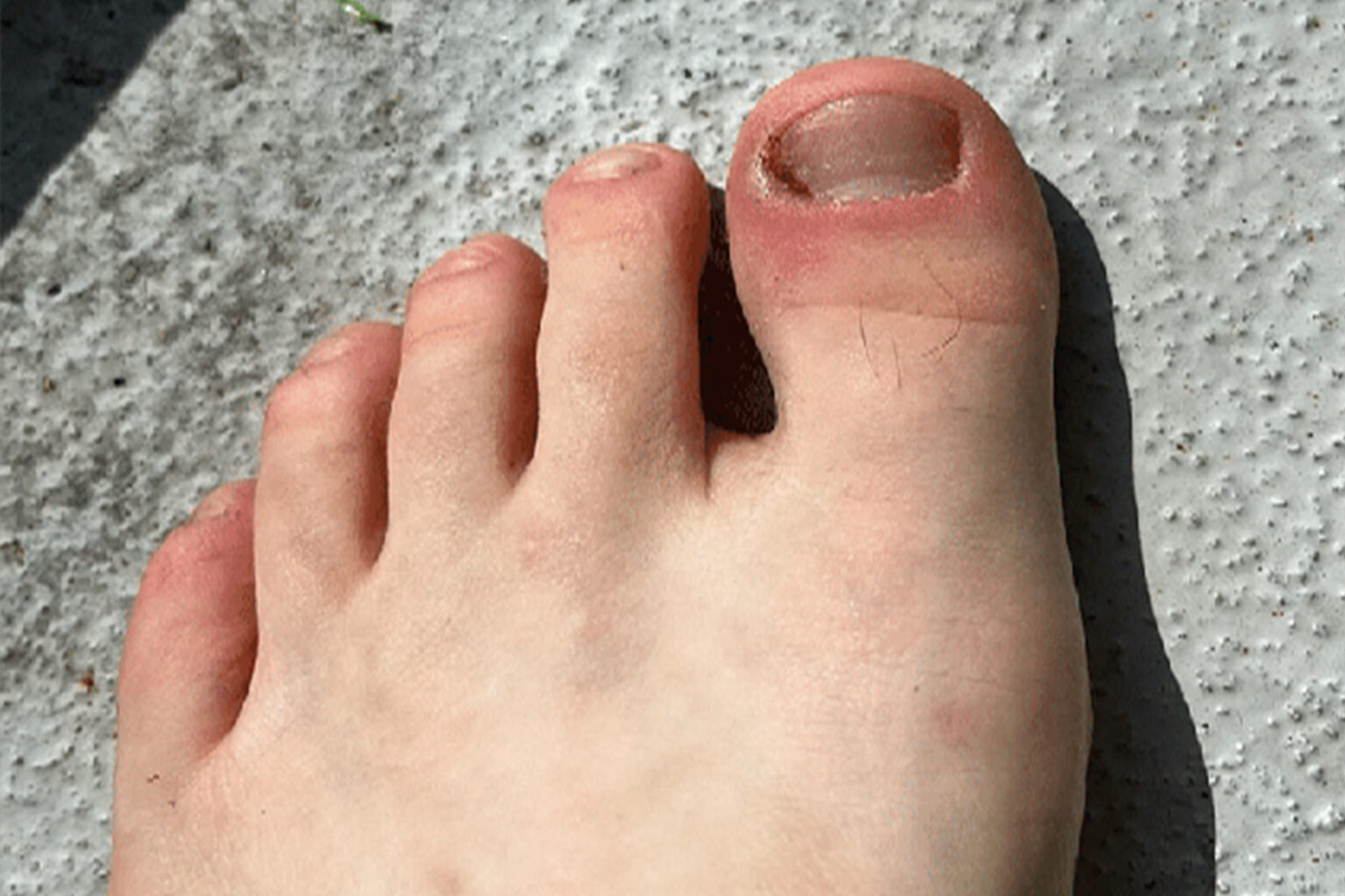 Paronychia Symptom, Causes and Podiatric Treatment