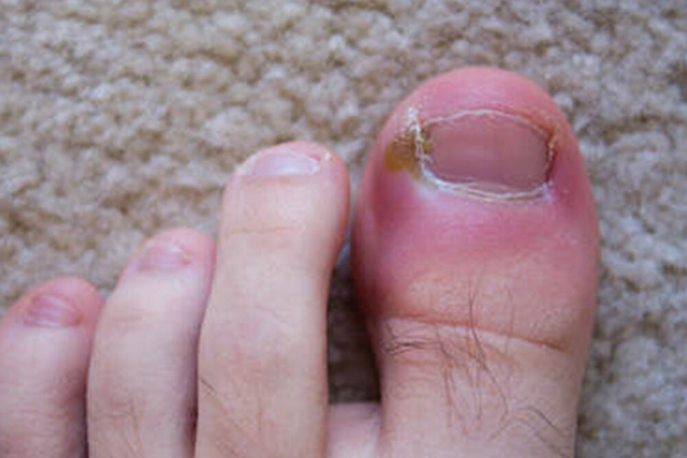 Paronychia Symptom, Causes and Podiatric Treatment