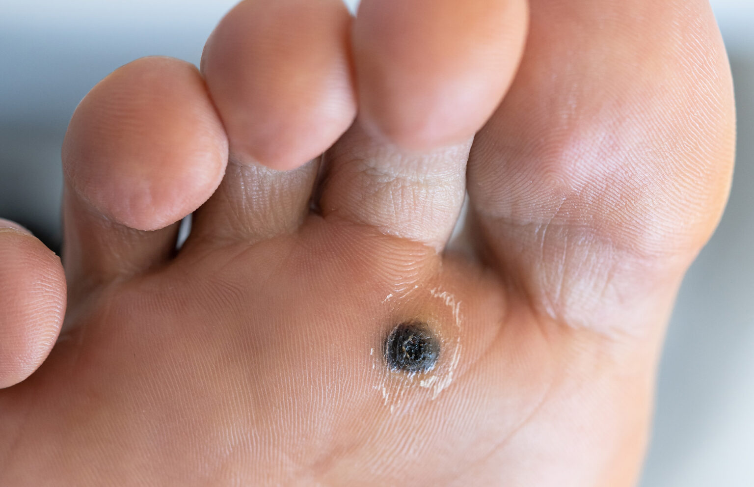 Effective Plantar Wart Removal at The Foot Practice