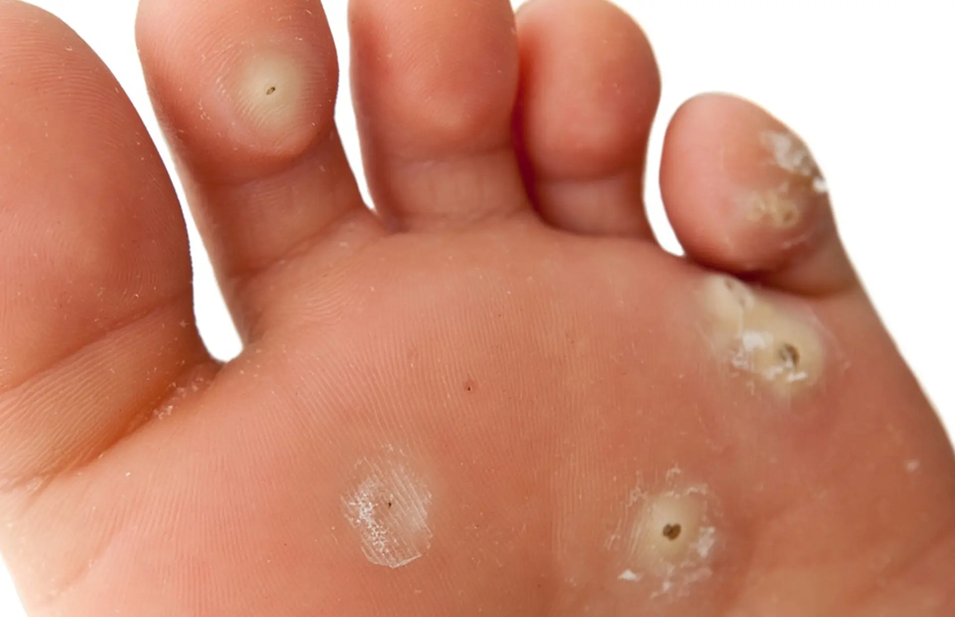 Plantar Wart Root Depth