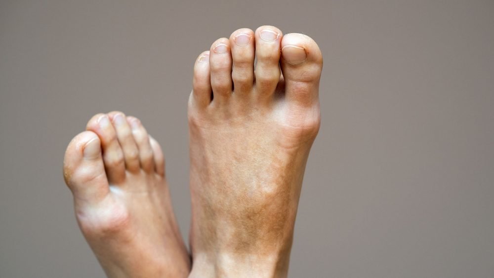 Corns and Calluses Treatment | The Foot Practice Singapore