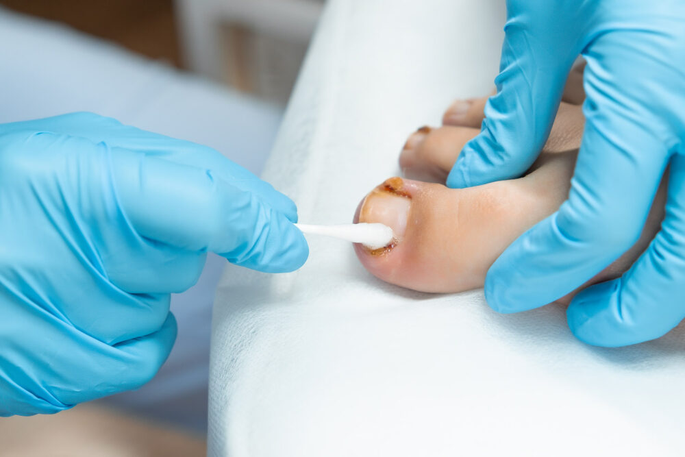 Manage Ingrown Toenails in Children and Babies through Podiatry
