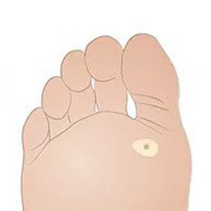 Treat Verruca Plantar Warts | Remedy by The Foot Practice Podiatrist