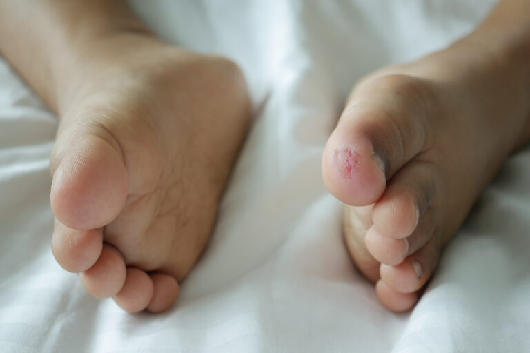 Paediatric Foot Blisters: Causes, Symptoms and Prevention Strategies