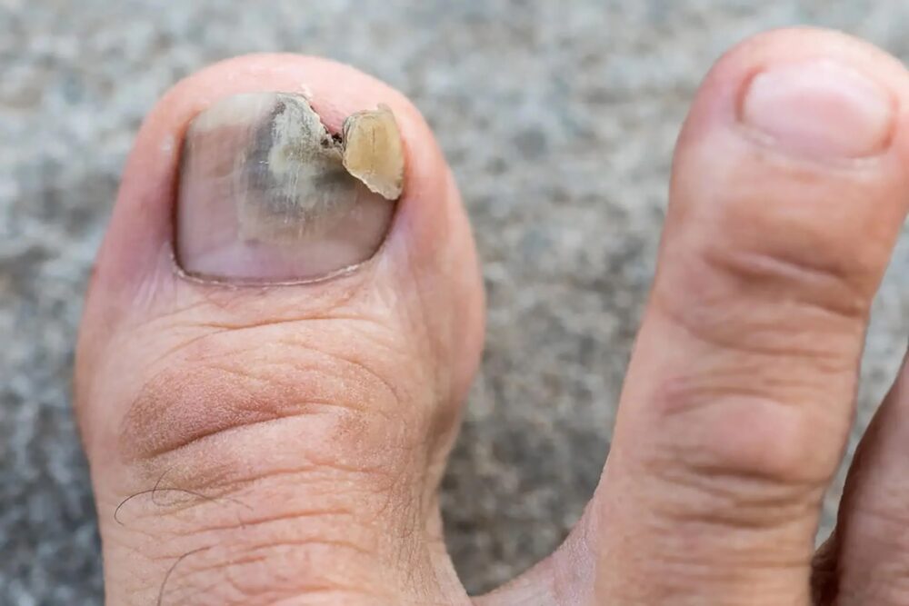Toenail Fungal Infection: Natural and Effective Treatment in Singapore