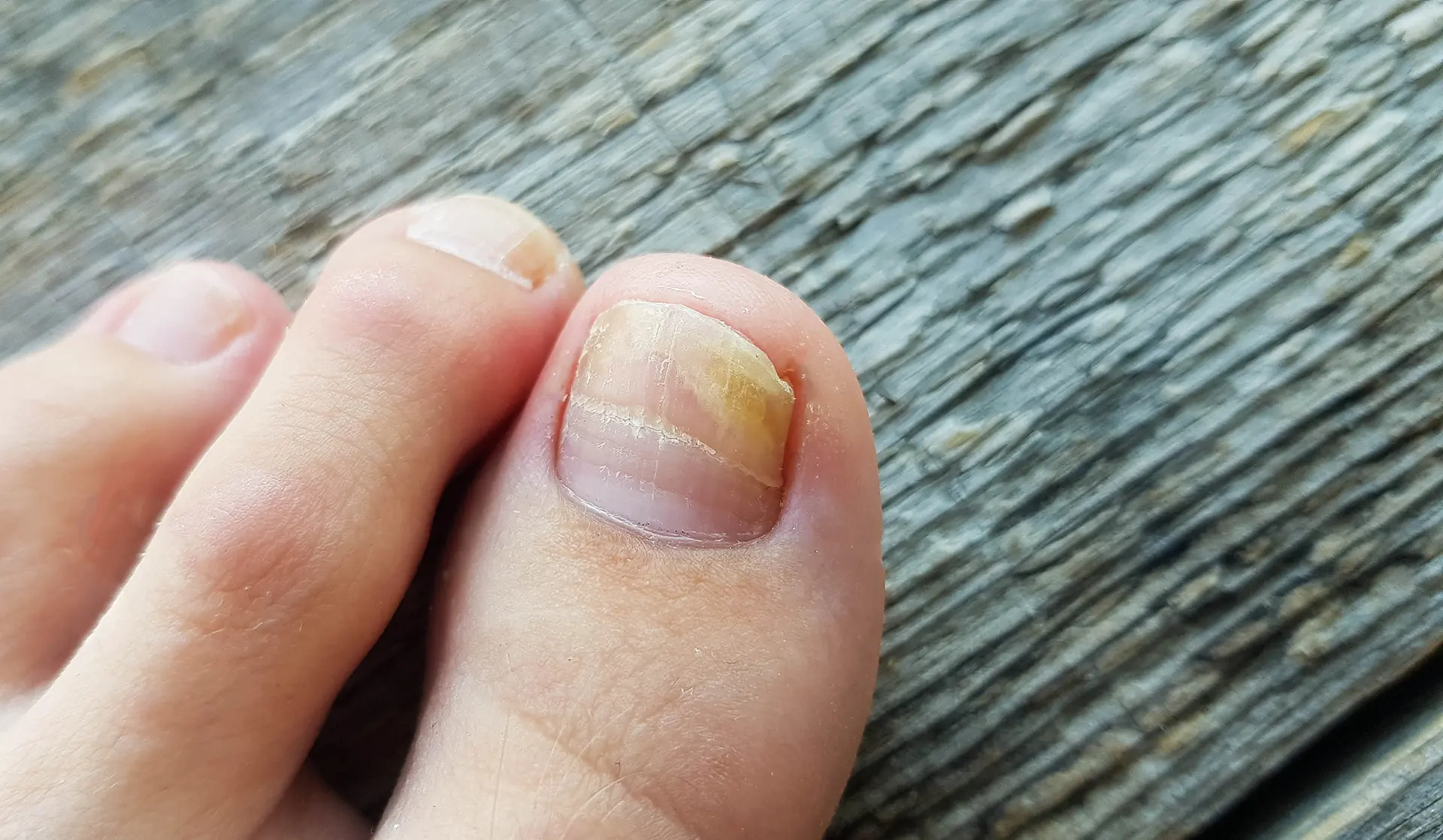 Discharge From Under Toenail