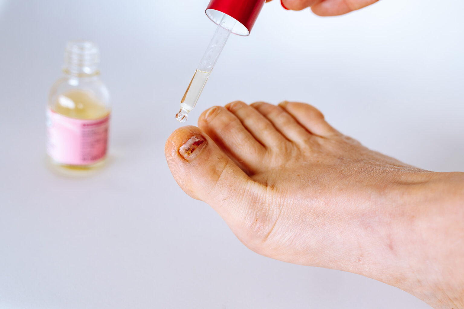 Toenail Fungus: Symptoms & Treatment in Singapore