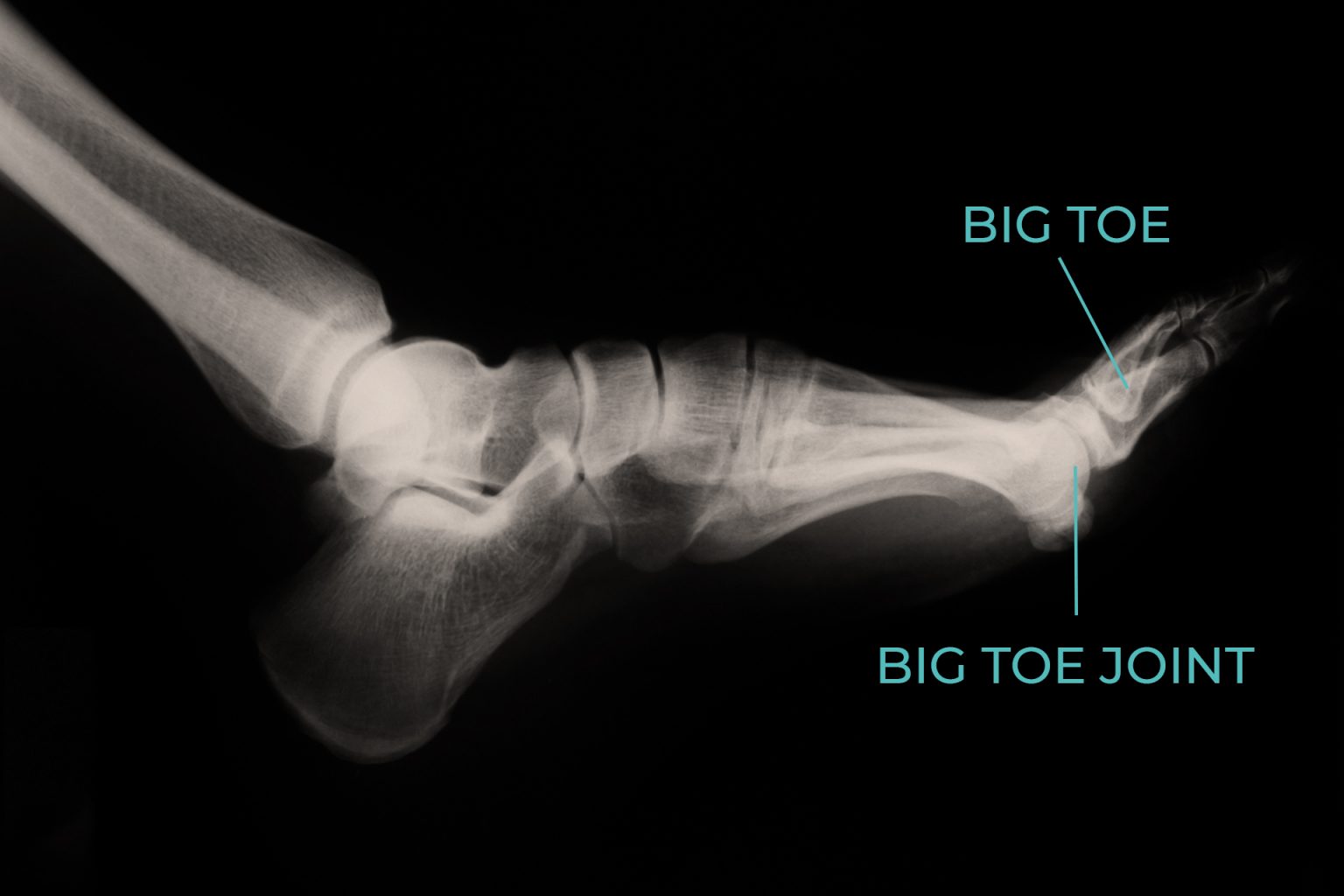 Turf Toe Injury Recovery | The Foot Practice Podiatry Singapore